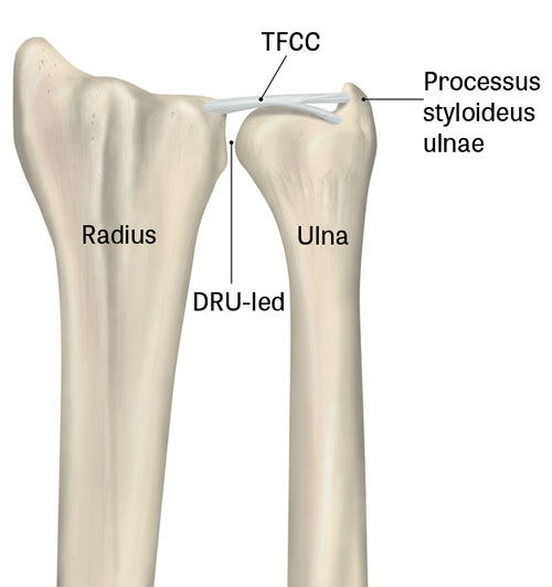 Distal radius­fraktur hos vuxna – Läkartidningen
